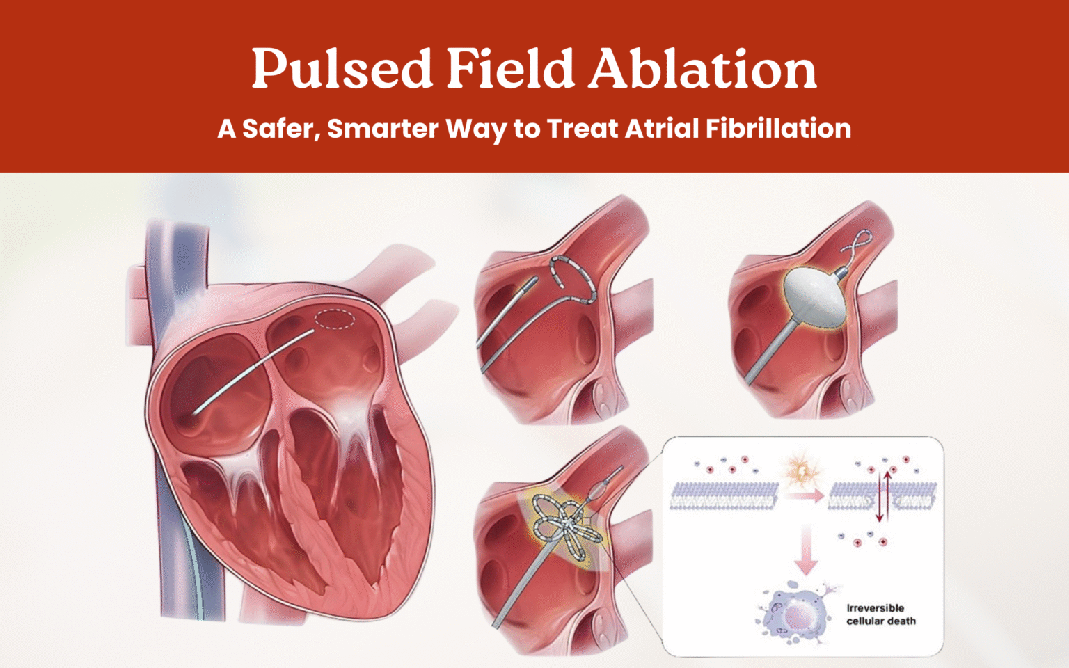 Pulsed Field Ablation (PFA): Smarter Way to Treat Atrial Fibrillation
