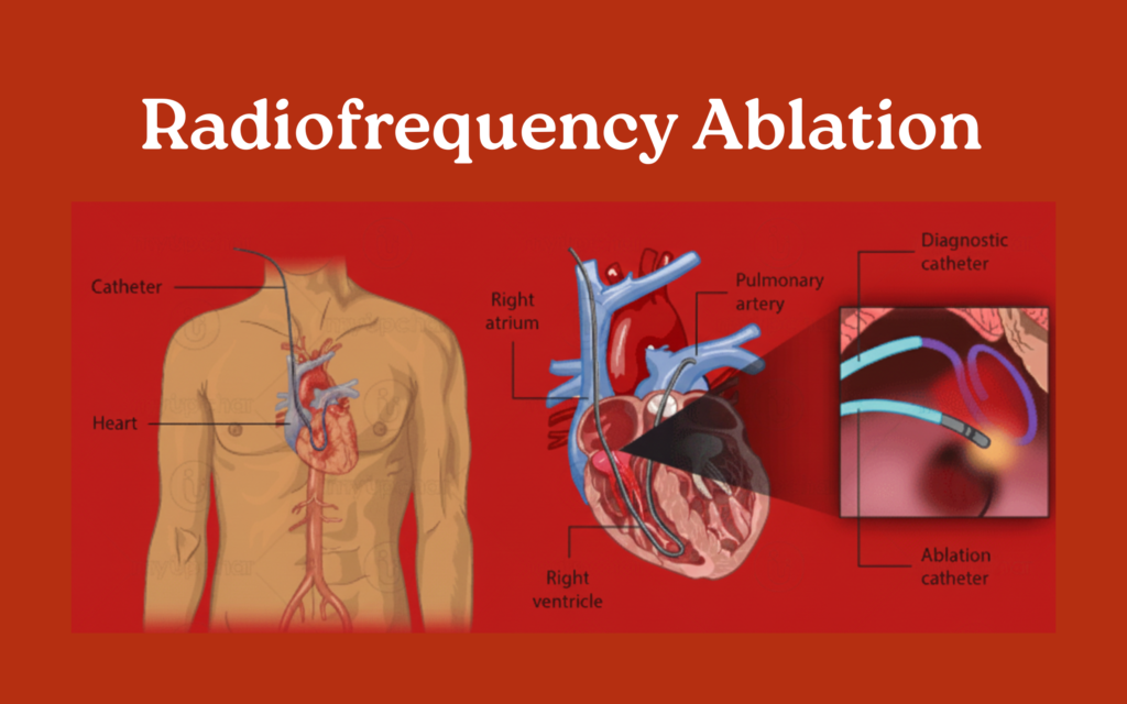 PFA vs. RF Ablation: A New Era in Atrial Fibrillation Treatment